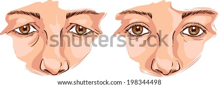 Eyelid Lift Stock Vector (Royalty Free) 198344498 - Shutterstock