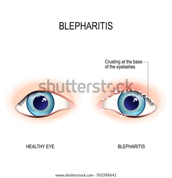 Eyes Human Blepharitis Crusting Eyelid Margins Stock Vector (Royalty ...