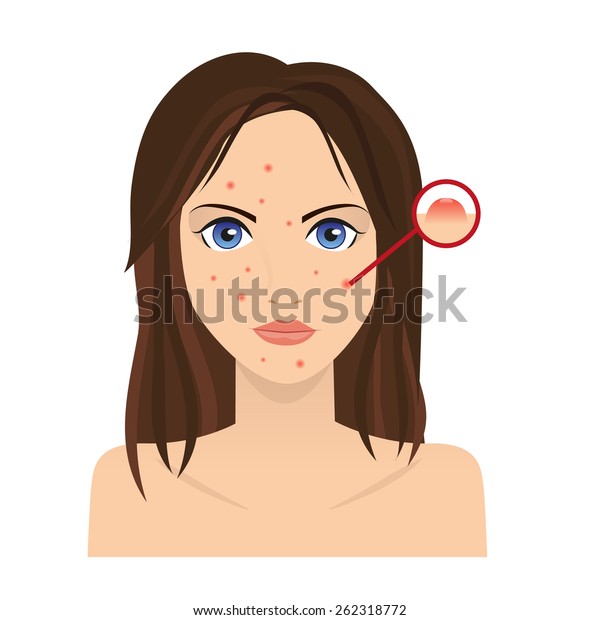 Face Acne Illustration: เวกเตอร์สต็อก (ปลอดค่าลิขสิทธิ์) 262318772 ...
