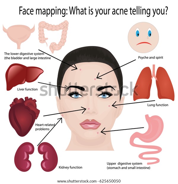 Vektor Stok Face Mapping What Your Acne Telling (Tanpa Royalti ...