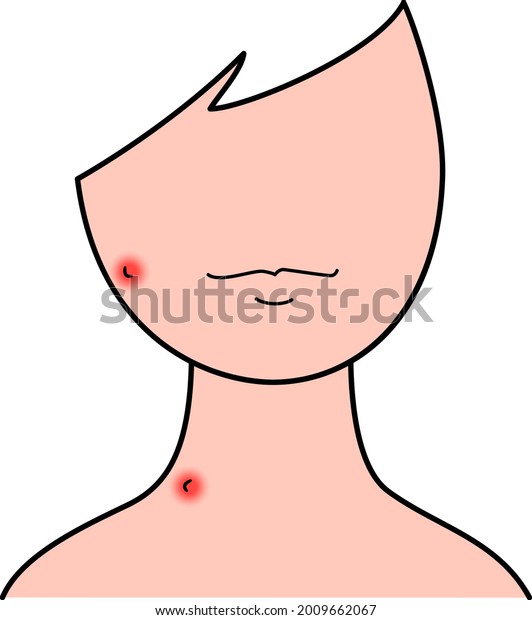Face Neck Insect Biteitchy Swollen Illustration Stock Vector (Royalty ...