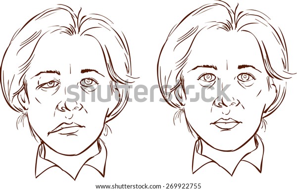 Face Paralysis Illustration 스톡 벡터(로열티 프리) 269922755 | Shutterstock
