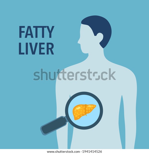 Fatty Liver Disease Vector Illustration Human Stock Vector (Royalty ...