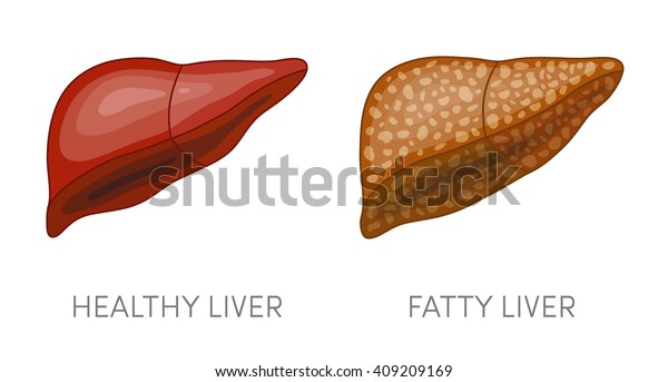 Fatty Liver Disease Vector Illustration Healthy Stock Vector (Royalty ...