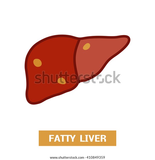 Fatty Liver Disease Vector Illustration Fatty Stock Vector (Royalty ...