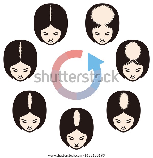 Female pattern hair loss set. Stages of baldness in women.