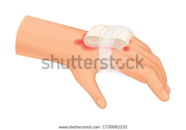First Aid Hand Ambustion Burn On Stock Vector (Royalty Free) 1730082232