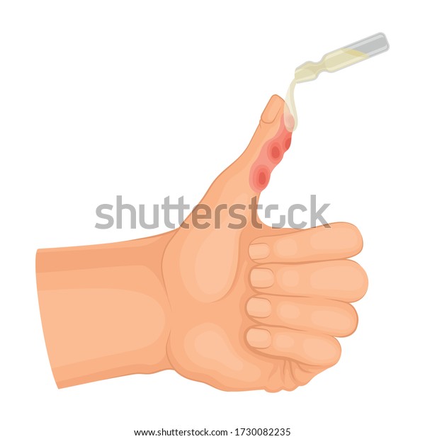 First Aid Hand Ambustion Burn On Stock Vector (Royalty Free) 1730082235 ...