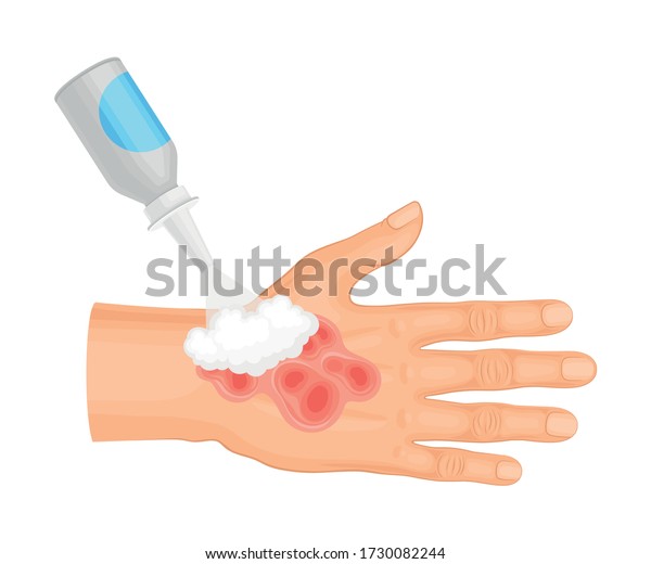First Aid Hand Ambustion Burn On Stock Vector (Royalty Free) 1730082244