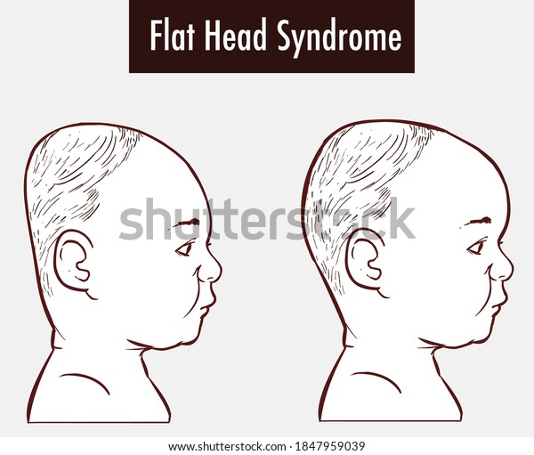 Flat Head Syndrome Brain Vector Illustration Stock Vector (Royalty Free ...