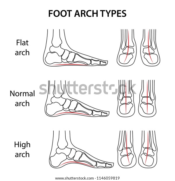 Foot Arch Types Set Black Foots Stock Vector (Royalty Free) 1146059819