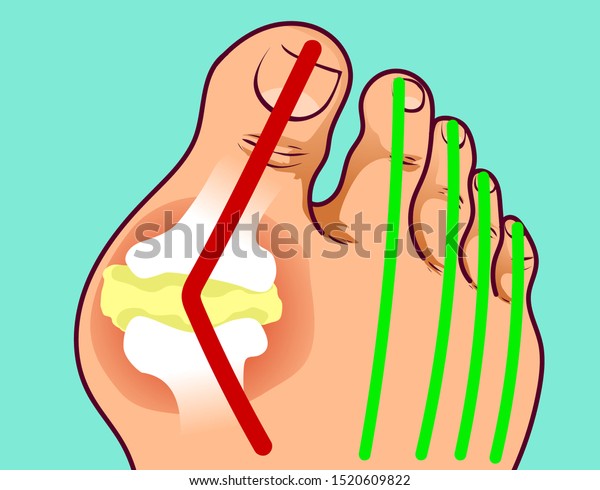 Foot Gout Beforeafter Vector Illustration Stock Vector (Royalty Free ...