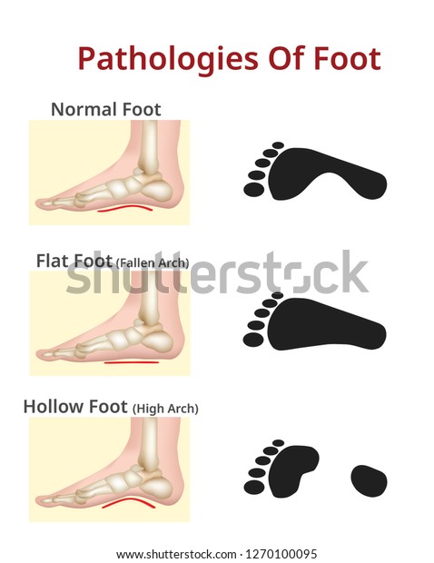 Foot Pathologies Normal Flat Hollow Foot Stock Vector (Royalty Free ...