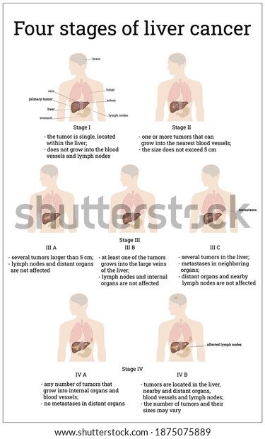 Four Stages Liver Cancer Five Substages Stock Vector (Royalty Free ...