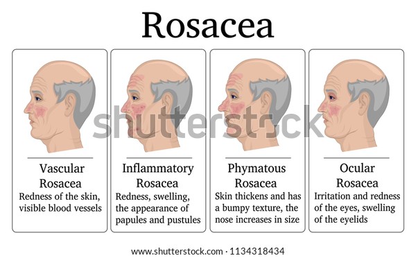 Four Types Rosacea Vascular Inflammatory Phymatous Stock Vector ...