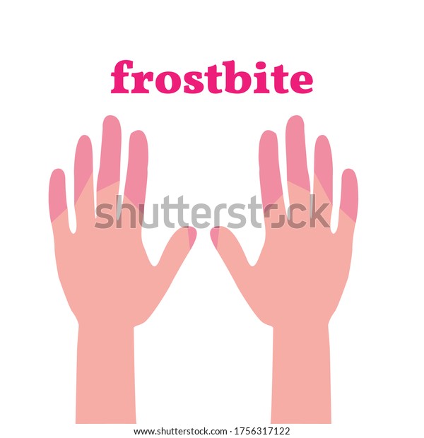Frostbite Hands Different Skin Colors Due Stock Vector (Royalty Free ...
