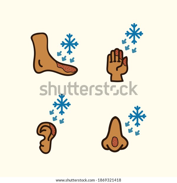 Frostbite Icons Linear Vector Color Icons Stock Vector (Royalty Free ...