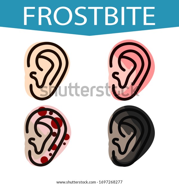 Frostbite Stages Frostbite Grass Effects Hypothermia: Vector có sẵn ...