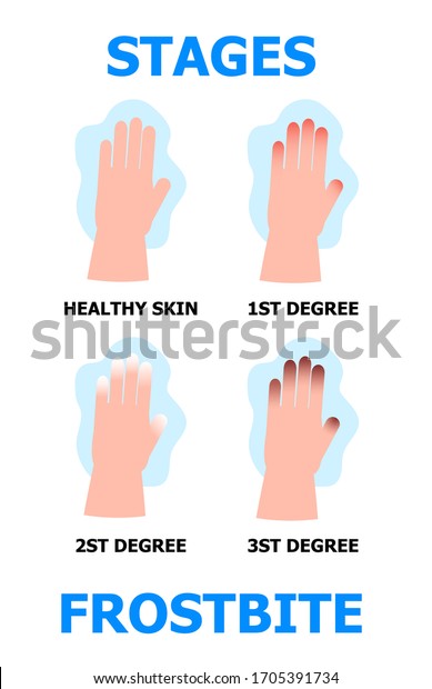Frostbite Stages Infographic Vector Hypothermia Winter Stock Vector ...