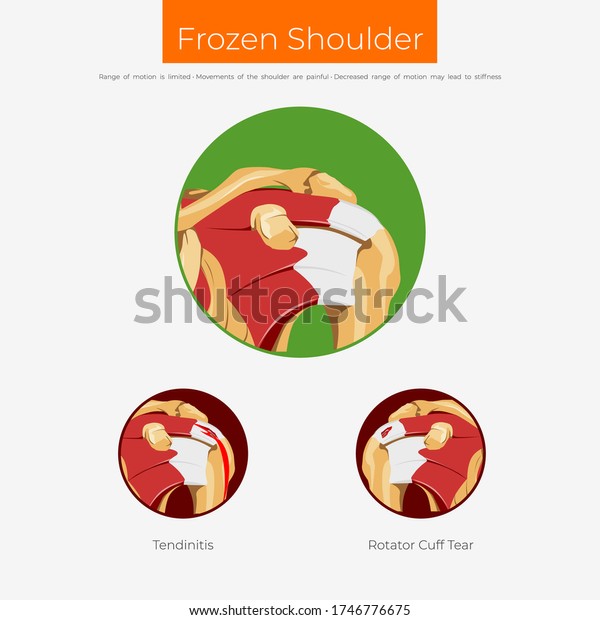 Frozen Shoulder Anatomy Scheme Poster Stock Vector (Royalty Free ...