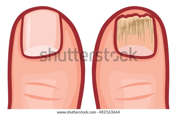 Fungal Infection Nails Vector Illustration Stock Vector (Royalty Free ...