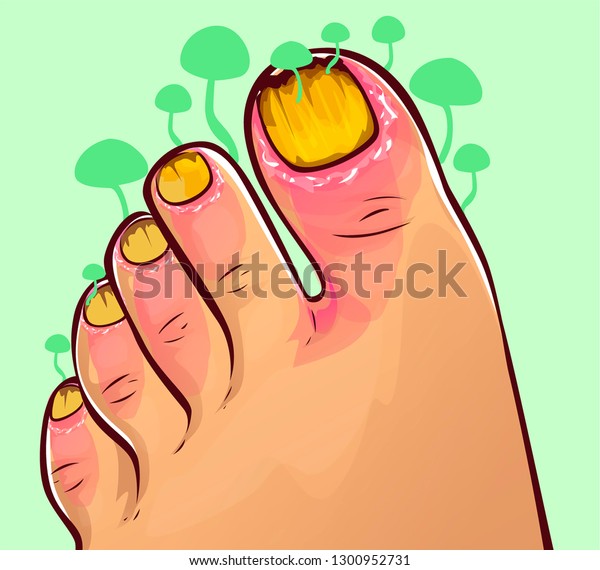 Fungal Infections Vector Illustration Stock Vector (Royalty Free ...