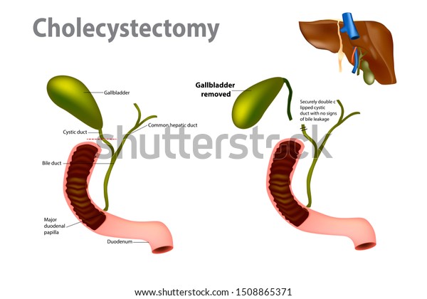 Gallbladder Removal Surgery Laparoscopic Cholecystectomy Stock Vector ...