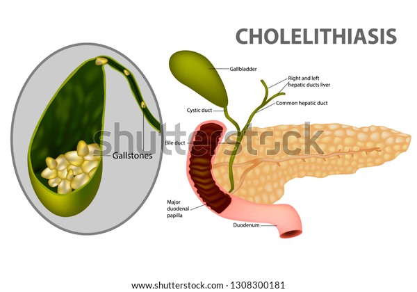 Gallstone Cholelithiasis Chronic Recurrent Hepatobiliary Disease 스톡 벡터 ...