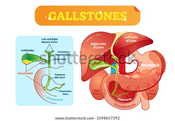 Vektor Stok Gallstones Anatomical Cross Section Vector Illustration ...