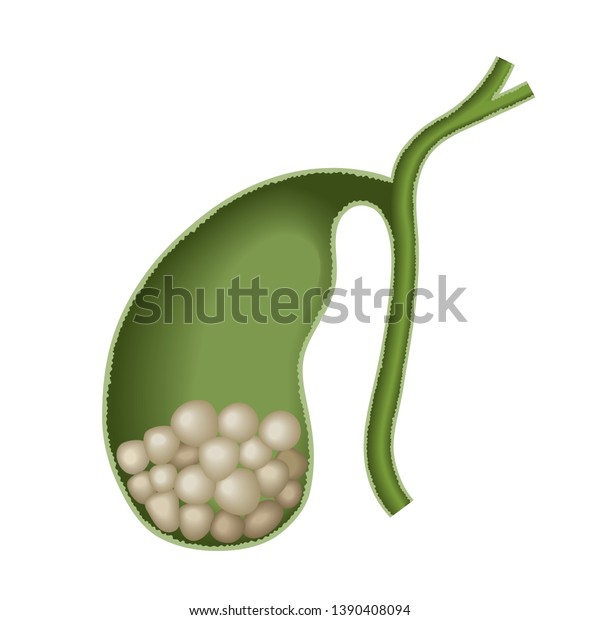 Gallstones Gallbladder Isolated Over White Background Stock Vector ...
