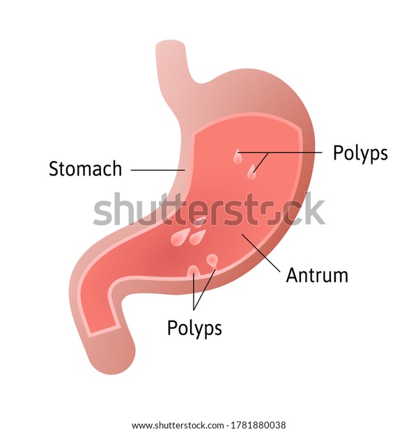 Gastric Polyps Masses Cells That Form Stock Vector (Royalty Free ...