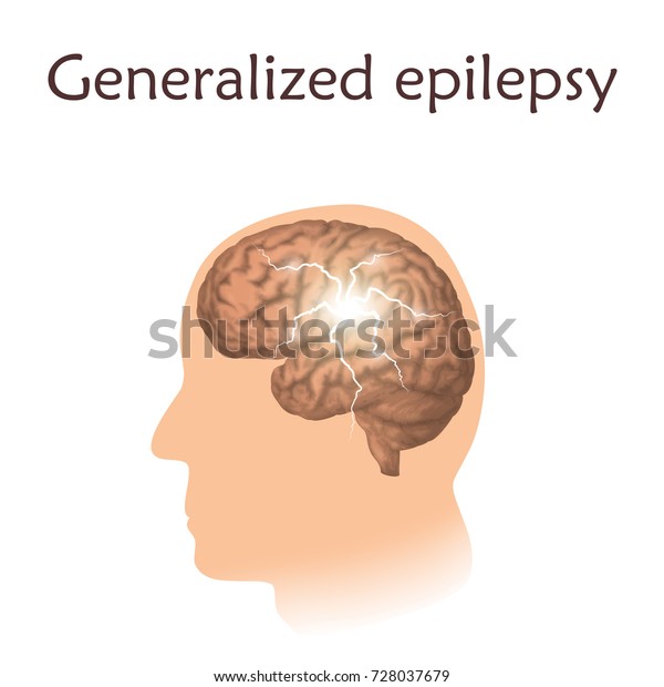 Generalized epilepsy. Vector medical illustration. White background ...