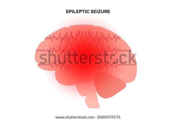 Generalized Partial Seizure Epilepsy Abnormal Brain Stock Vector ...