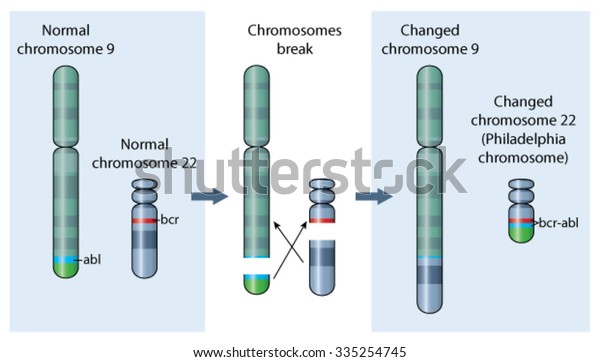Genetic Abnormality Chromosome 22 Factor Chronic Stock Vector (Royalty ...