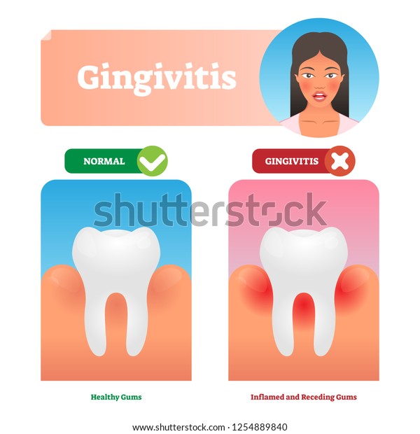 Gingivitis Vector Illustration Medical Oral Mouth Stock Vector (Royalty ...
