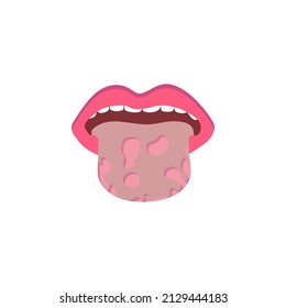 750 Oral Thrush Images, Stock Photos & Vectors | Shutterstock