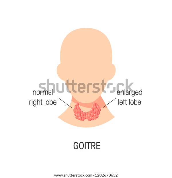 Goiter Disease Concept Vector Medical Illustration 스톡 벡터(로열티 프리 ...