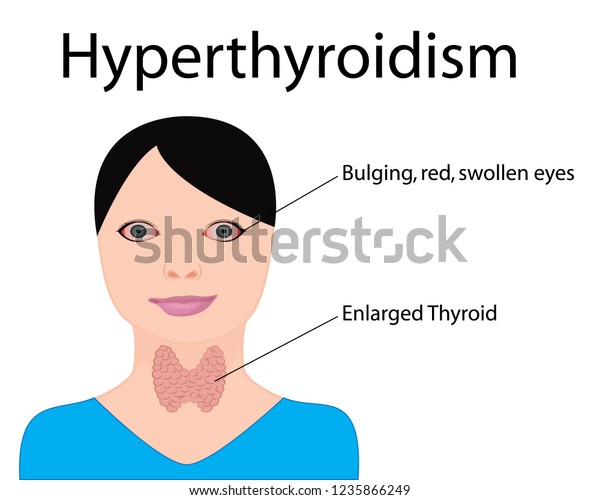 Goiter Enlarged Thyroid Endocrine Disfunction Vector Stock Vector ...