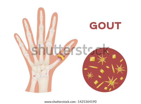 gout in human hand vector / human, anatomy