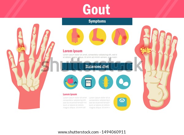 Gout Vector Cartoon Isolated Art On Stock Vector (Royalty Free ...