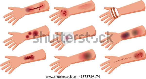 Grupo de lesión sobre lesiones en: vector de stock (libre de regalías ...