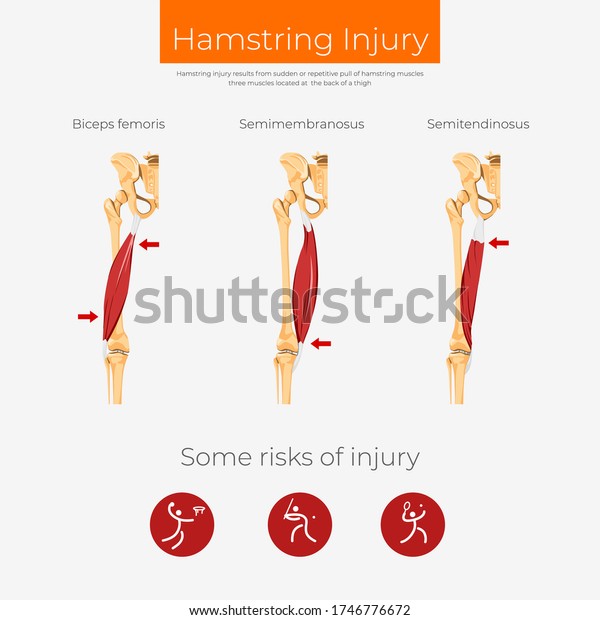 Hamstring Injury Anatomy Scheme Poster Stock Vector (Royalty Free ...