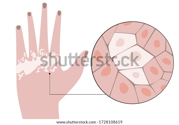 Hand Vitiligo Structure Skin Cells Patient: เวกเตอร์สต็อก (ปลอดค่า ...