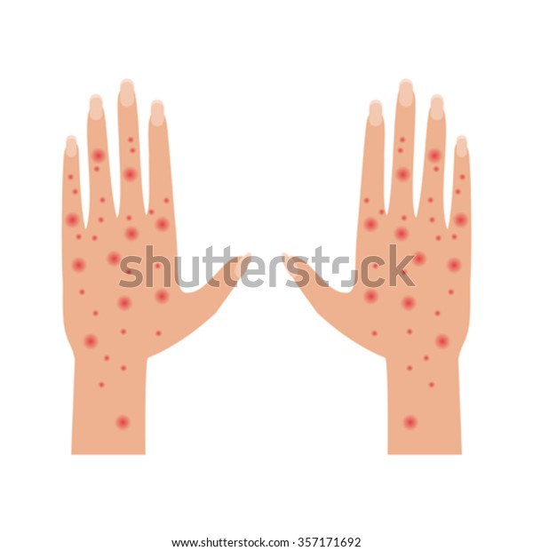 Hands Dermatologic Disease Skin Rash Eczema Stock Vector (Royalty Free ...