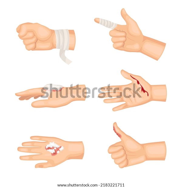 Hands Different Types Wounds Cartoon Illustration: vetor stock (livre ...
