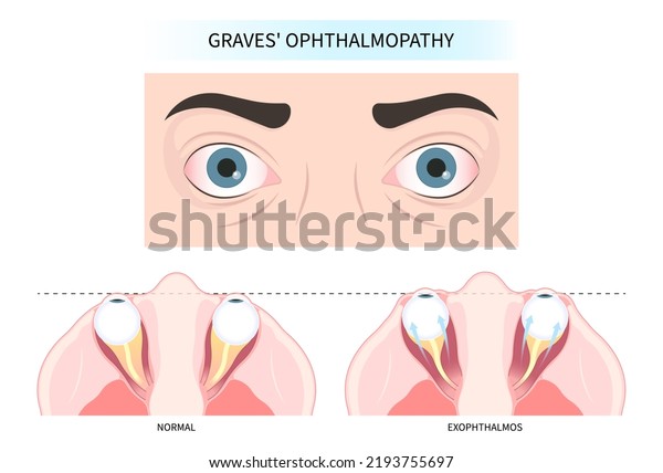 Hashimotos Thyroiditis Graves Disease Eye Swollen: เวกเตอร์สต็อก (ปลอด ...