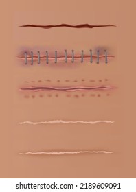 6,469 Surgical stitches Images, Stock Photos & Vectors | Shutterstock