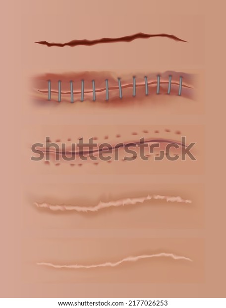 상처세트, 피부 흉터, 바느질, 베인 상처 스톡 벡터(로열티 프리) 2177026253 | Shutterstock