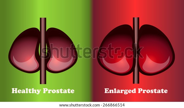Healthy Enlarged Prostate Vector Illustration 库存矢量图（免版税）266866514 ...