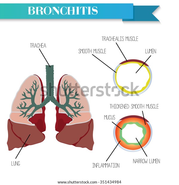 Healthy Inflamed Bronchus Chronic Bronchitis Stock Vector (Royalty Free ...